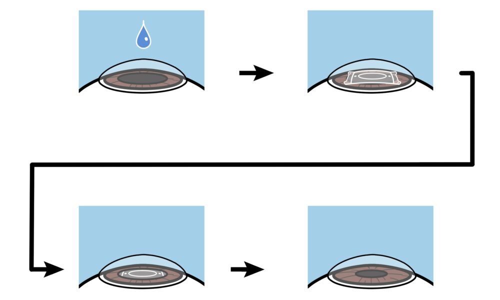 ICL手術と白内障手術の違いは？手術内容の違いやレンズの違いについて眼科医が解説！｜ICL総研