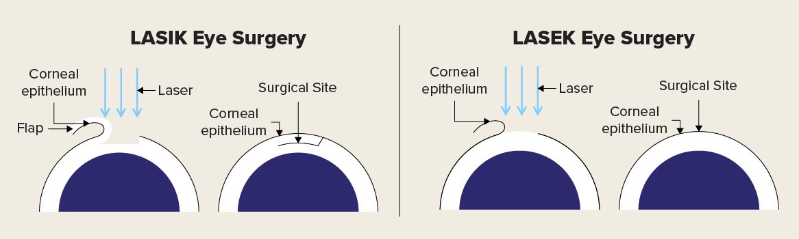 屈折矯正手術「LASEK(ラゼック)」とは？レーシックとの違いやメリット・デメリットを解説｜ICL総研